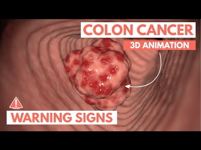 Colon Cancer: Recognizing the Warning Signs | SchoolTube Colon Cancer: Recognizing the Warning Signs | SchoolTube